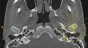 Temporomandibular Joint (TMJ) Imaging using Cone Beam CT
