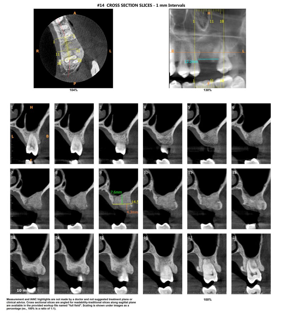 Implant Workups using Cone Beam CT | Reveal Diagnostics