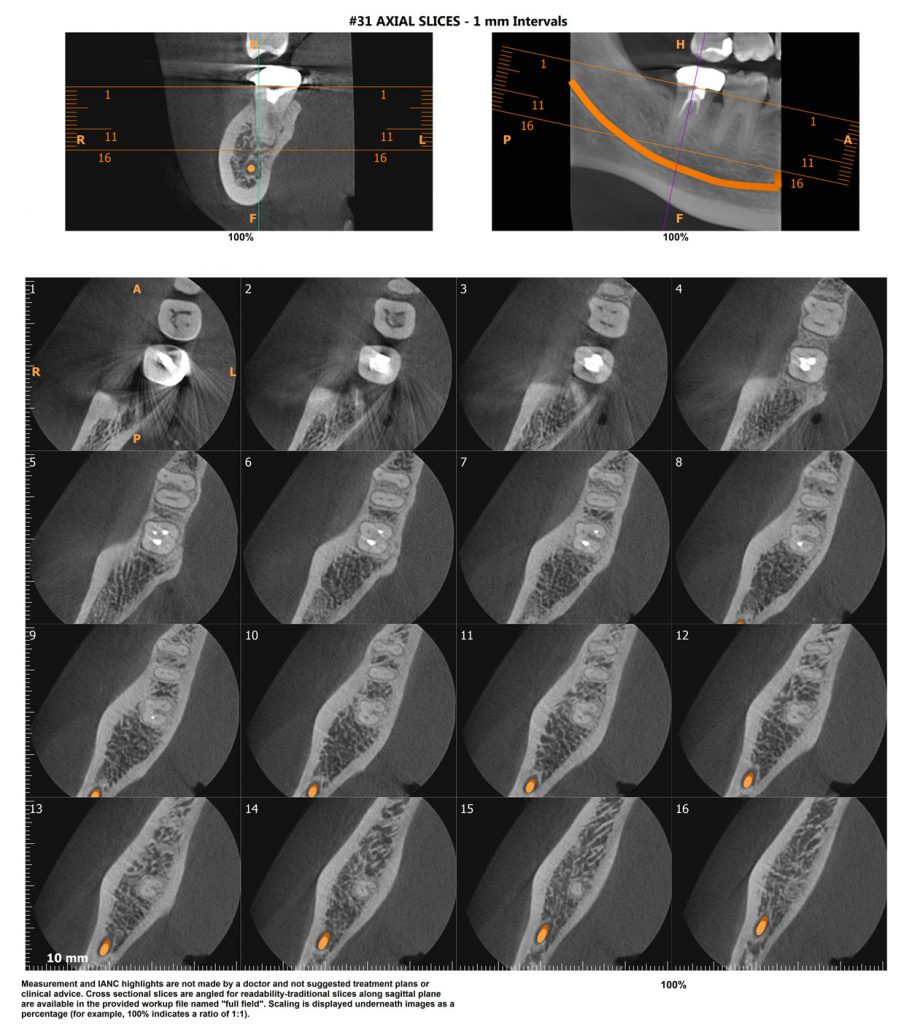 Endo Workups using Cone Beam CT | Reveal Diagnostics