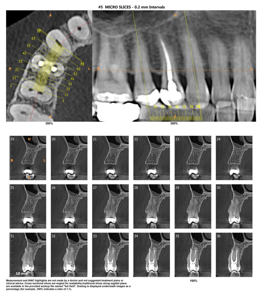 Endo Workups using Cone Beam CT | Reveal Diagnostics