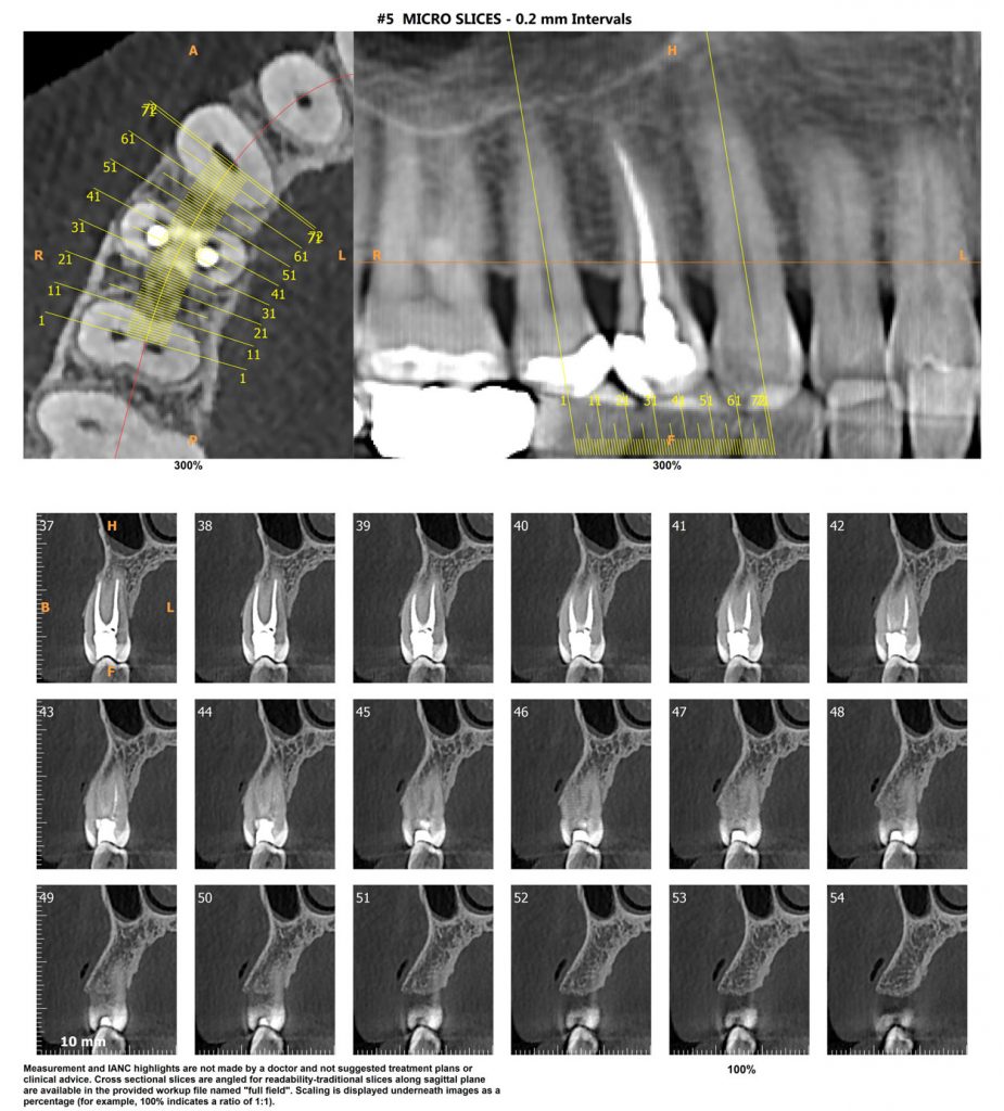 Endo Workups using Cone Beam CT | Reveal Diagnostics