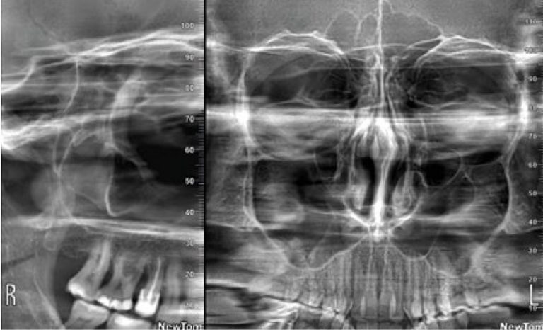 2D Dental X-Rays | Reveal Diagnostics